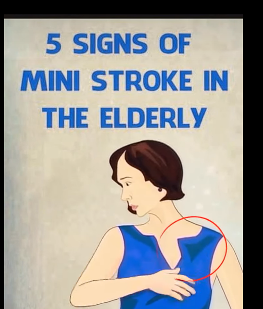 Understanding Mini Strokes in Older Adults: Key Facts to Know ...